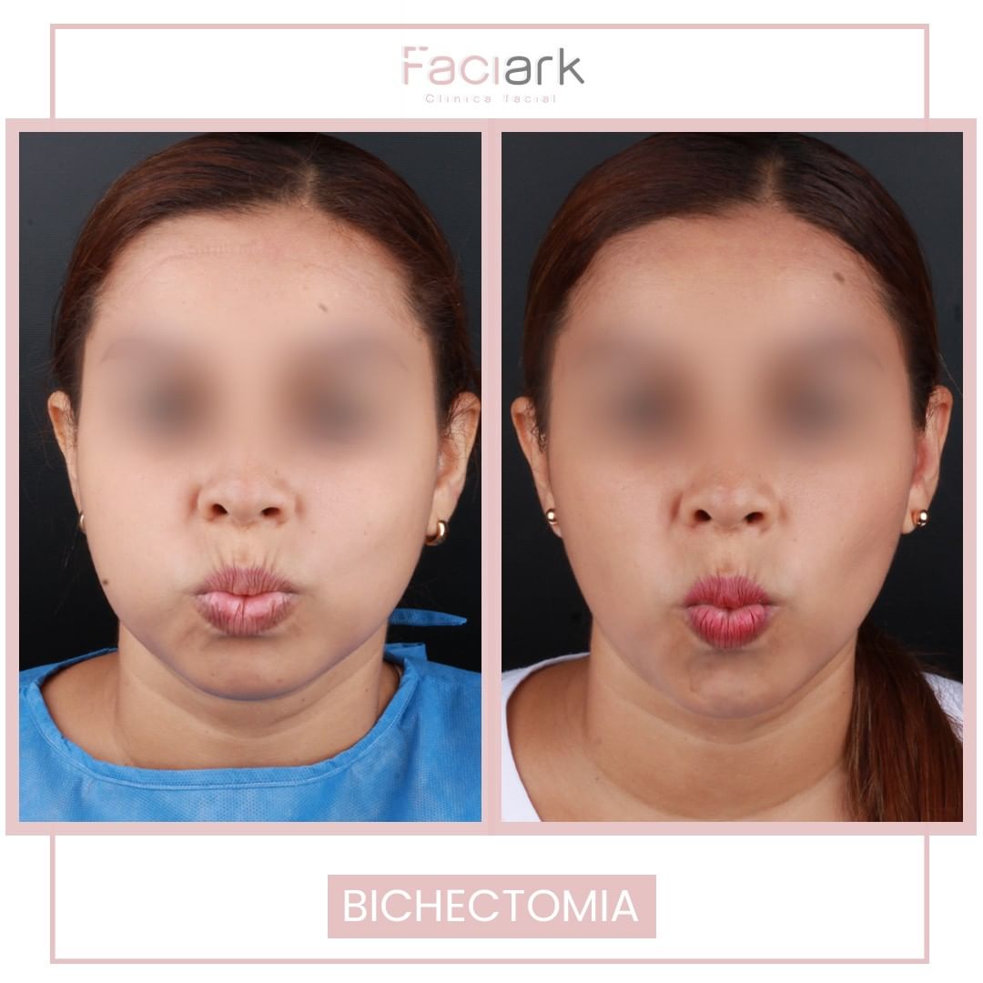 BICHECTOMIA – Dentark Clínica Orofacial